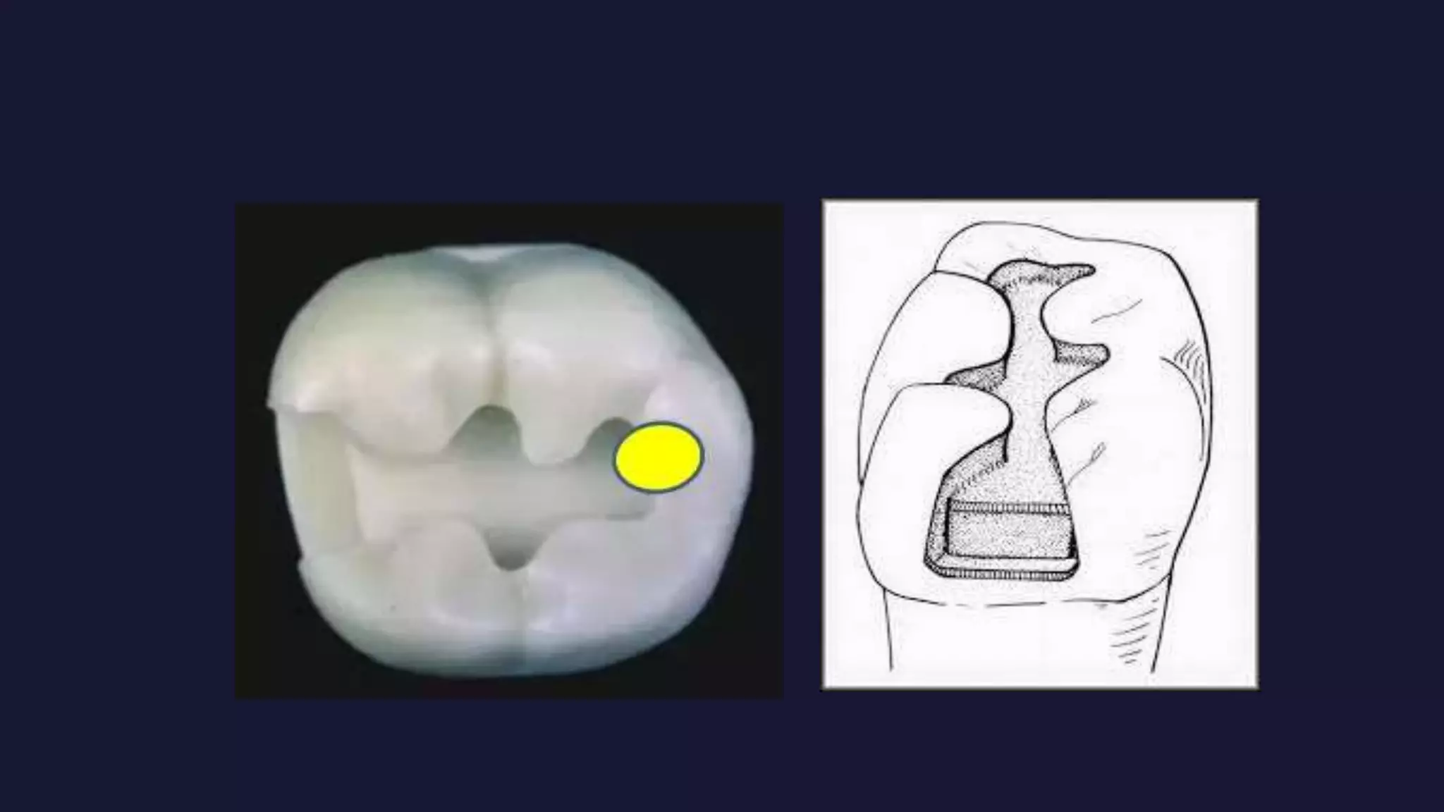 Class 2 cavity amalgam | PPTX