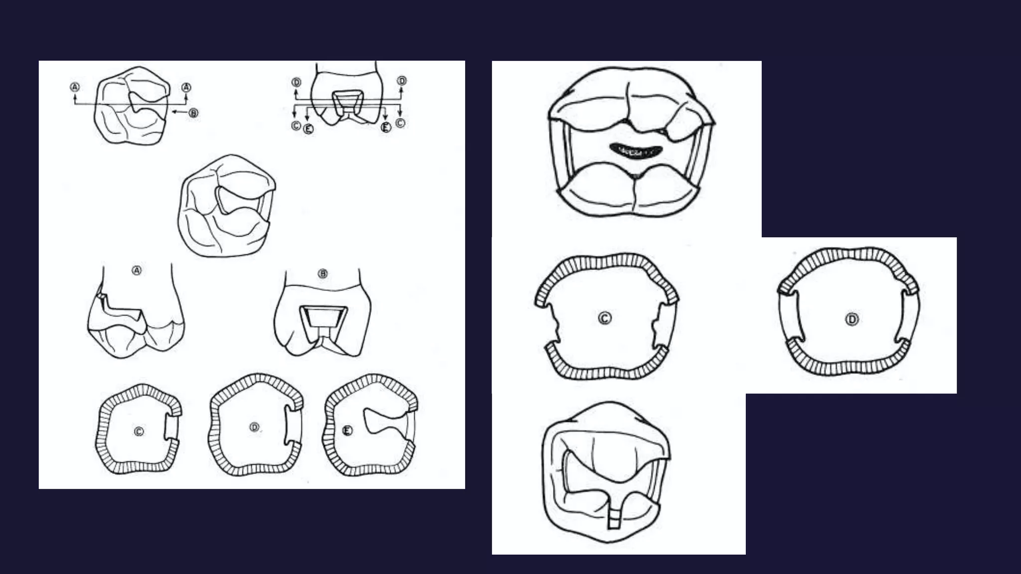 Class 2 cavity amalgam | PPTX