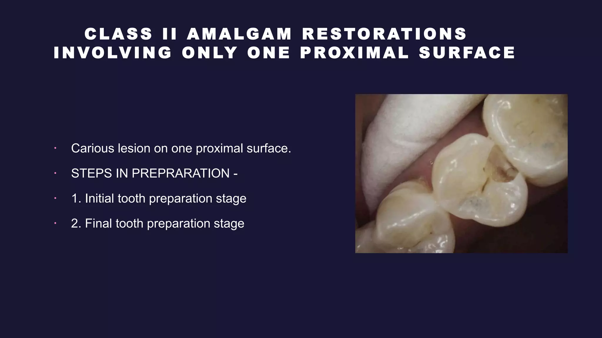 Class 2 cavity amalgam | PPTX