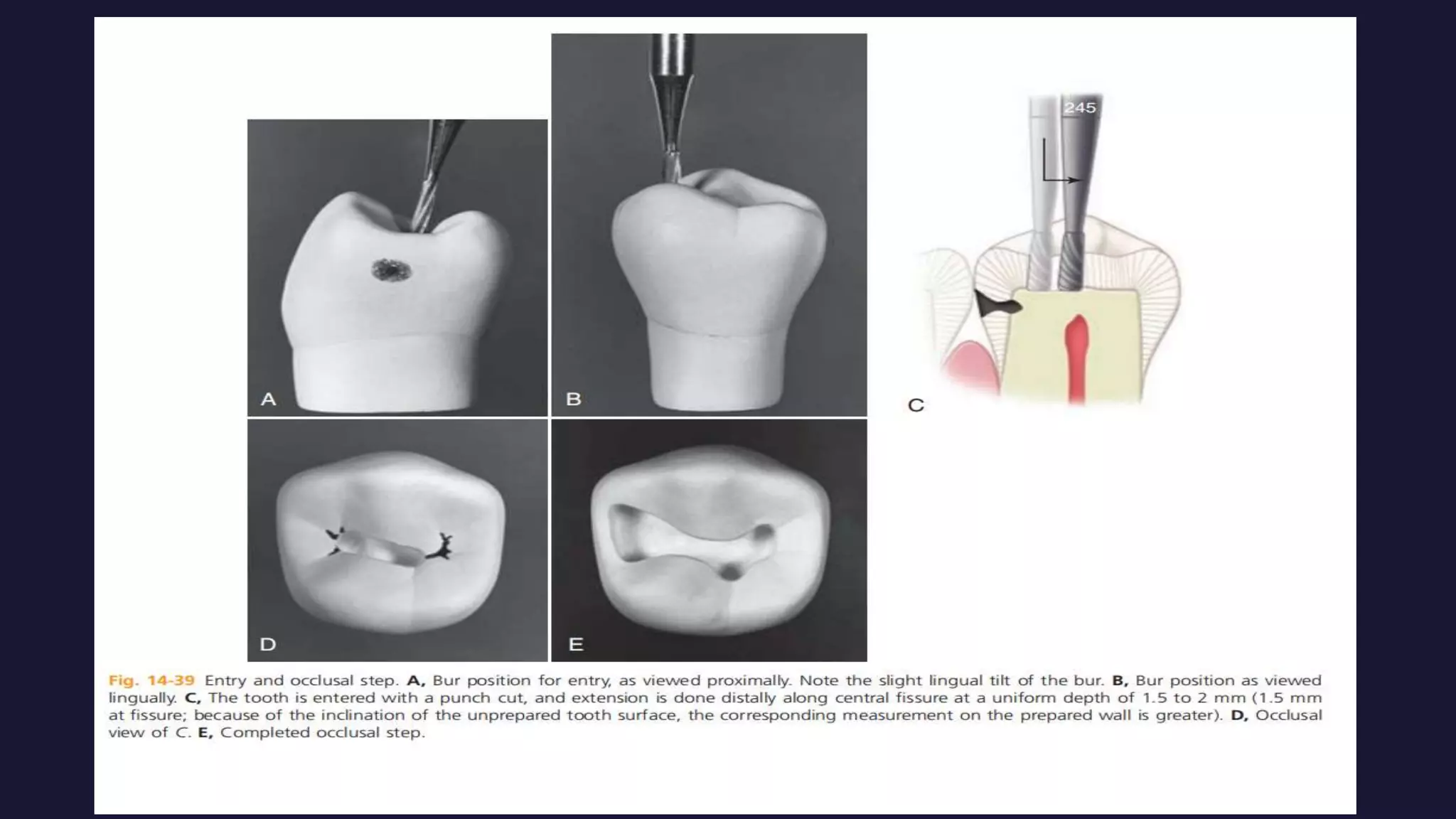 Class 2 cavity amalgam | PPTX