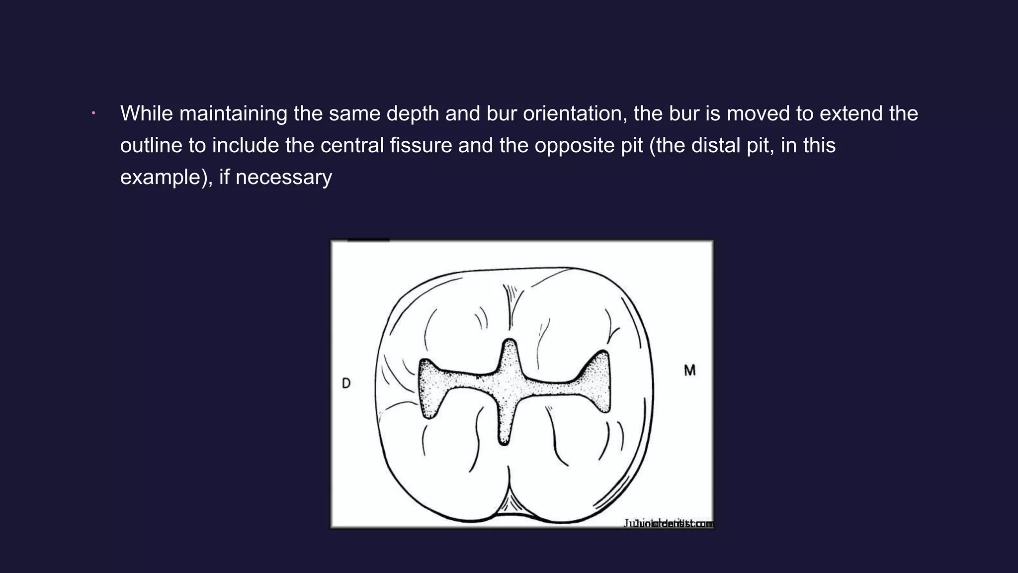 Class 2 cavity amalgam | PPTX