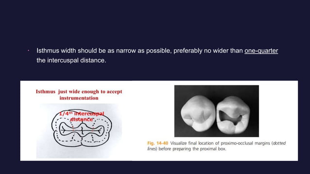 Class 2 cavity amalgam | PPTX | Dental Health | Diseases and Conditions