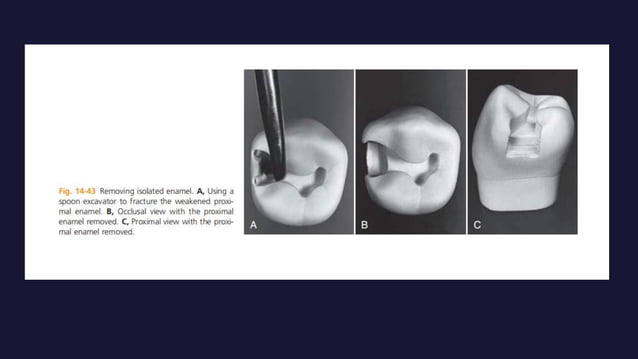 Class 2 cavity amalgam | PPTX | Dental Health | Diseases and Conditions