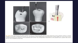 Class 2 cavity amalgam | PPTX