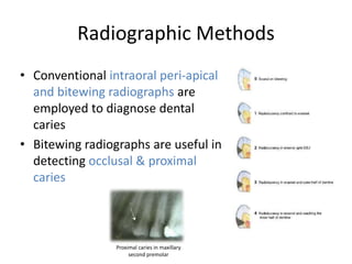 Class 2 Caries & Diagnostic Aids in Endodontics | PPTX