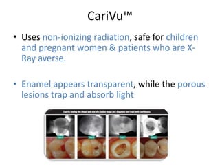 Class 2 Caries & Diagnostic Aids in Endodontics | PPTX