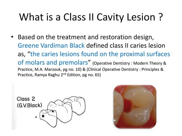 Class 2 Caries & Diagnostic Aids in Endodontics | PPTX | Dental Health ...