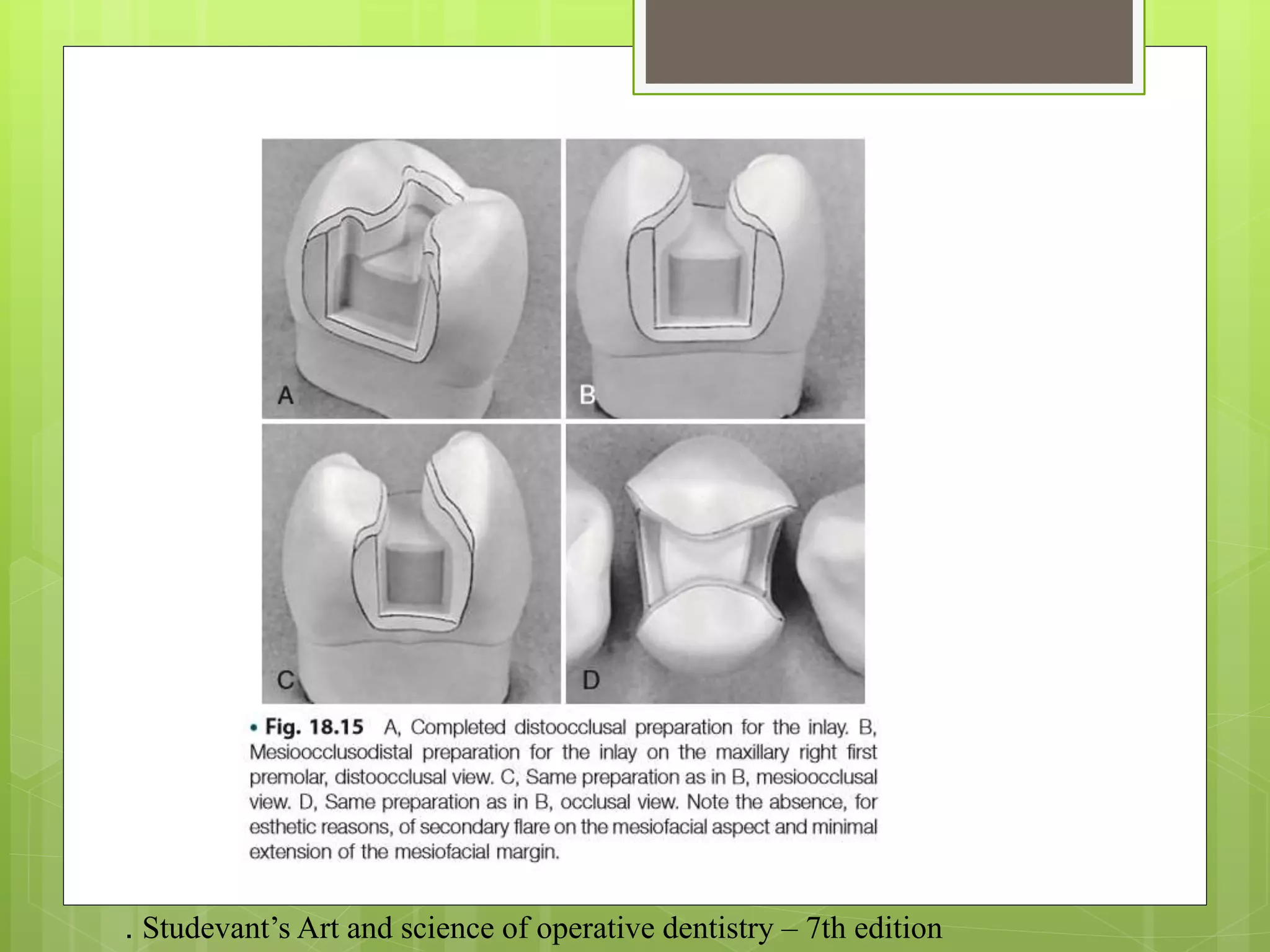 class 2 inlay 1.pptx