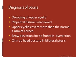 Lids and Adnexa Class3 - Ptosis | PPTX