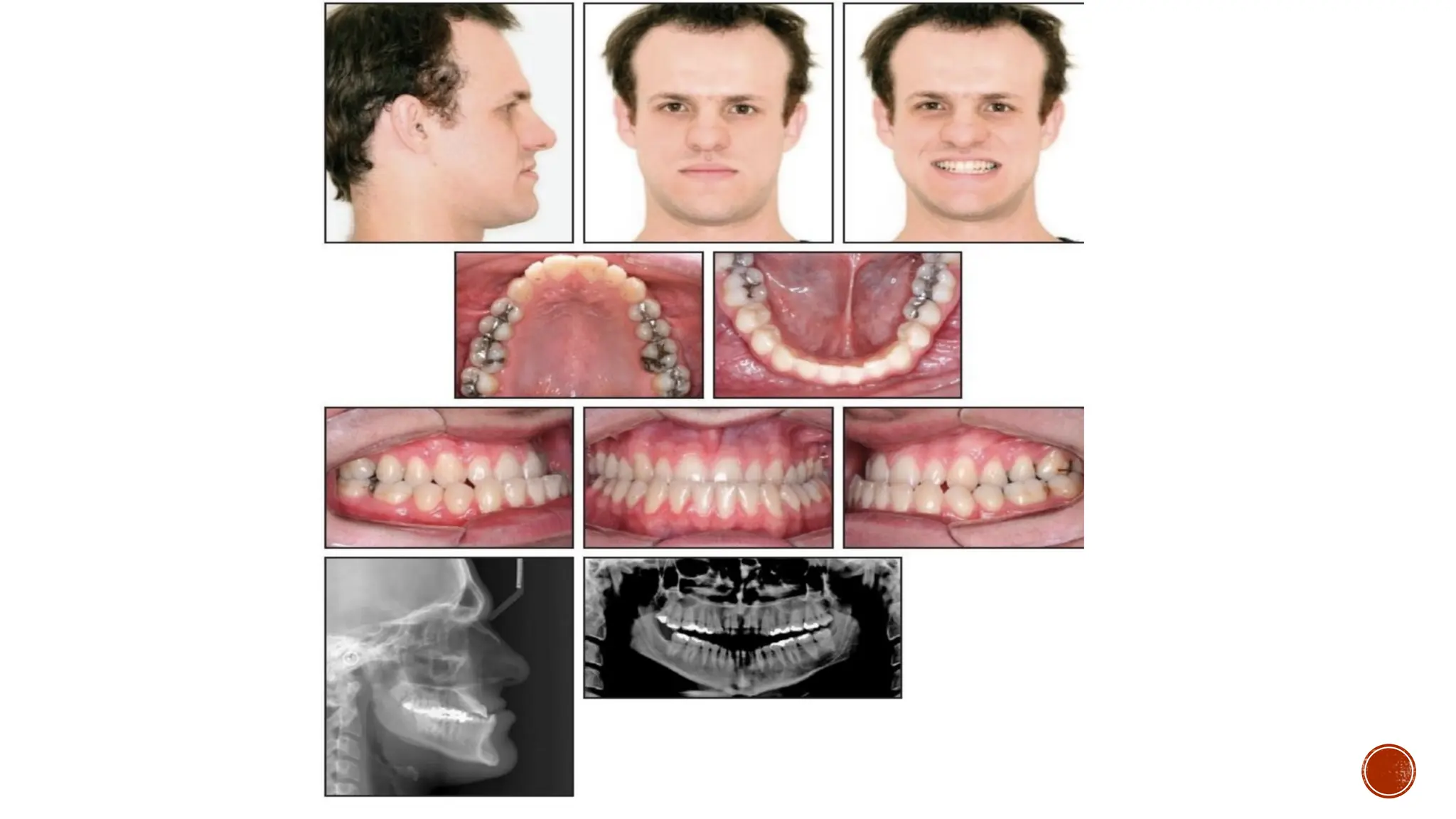 Class 3 malocclusion class III malocclusion profit | PPT