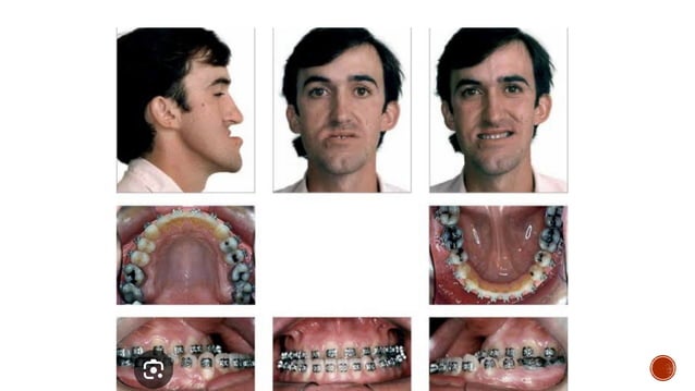 Class 3 malocclusion class III malocclusion profit | PPT