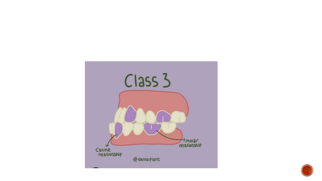 Class 3 malocclusion class III malocclusion profit | PPT