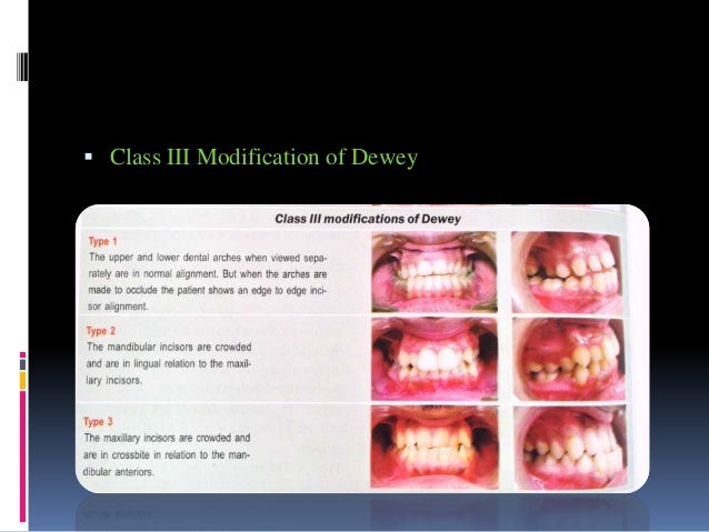 Class III malocclusion by sooraj s pillai