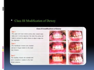 CLASS III MALOCCLUSION IN ORTHODONTICS | PPTX