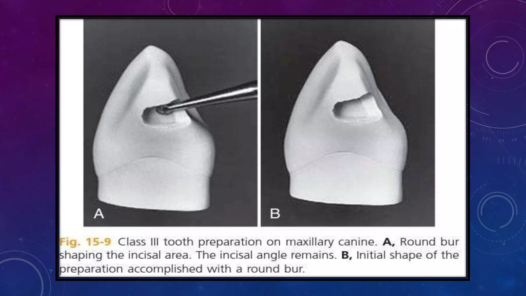 Class 3 tooth preparation | PPTX