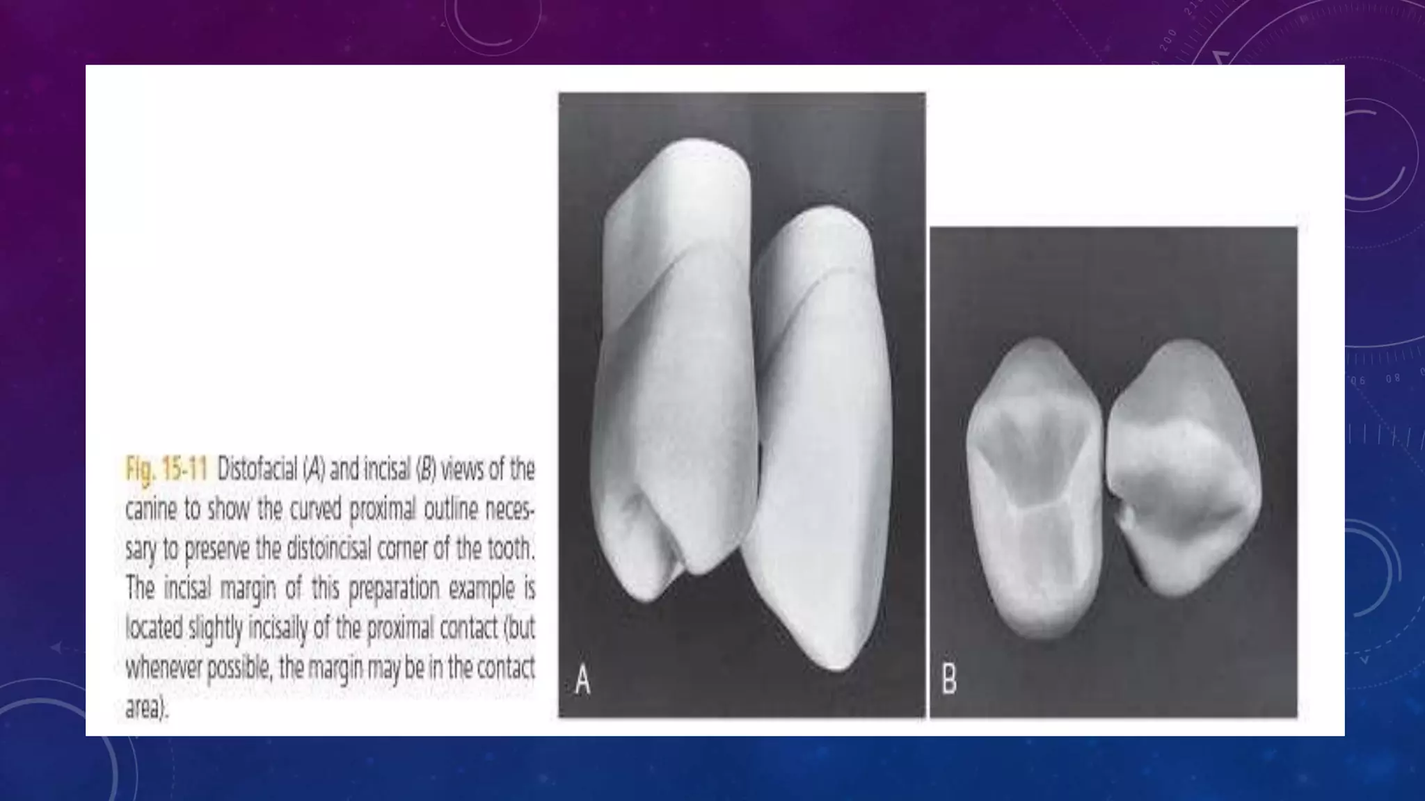 Class 3 tooth preparation | PPTX