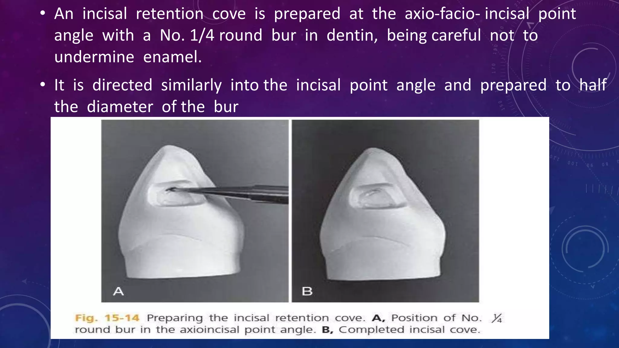 Class 3 tooth preparation | PPTX