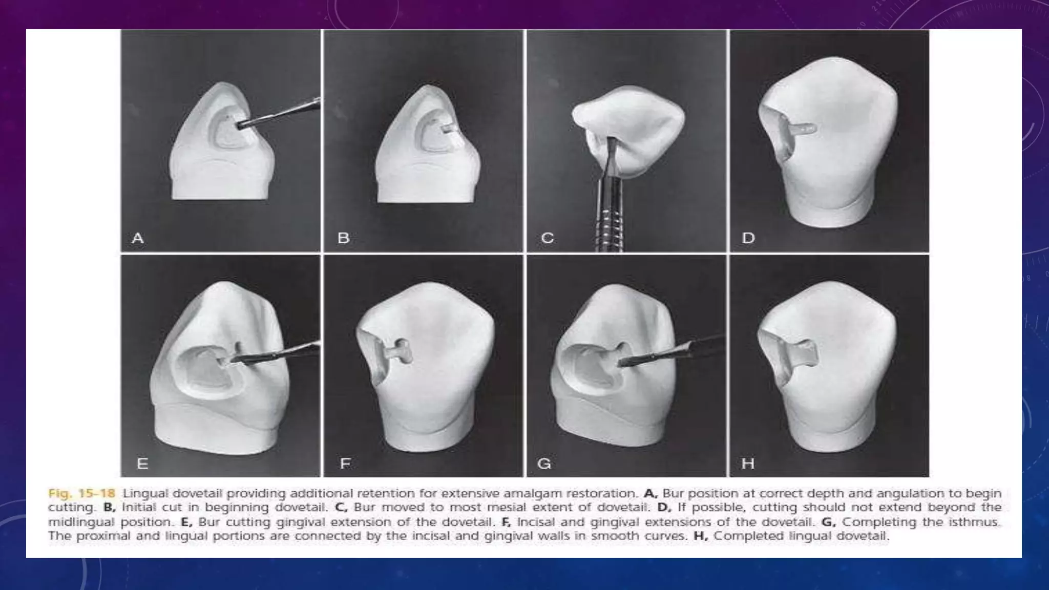 Class 3 tooth preparation | PPTX