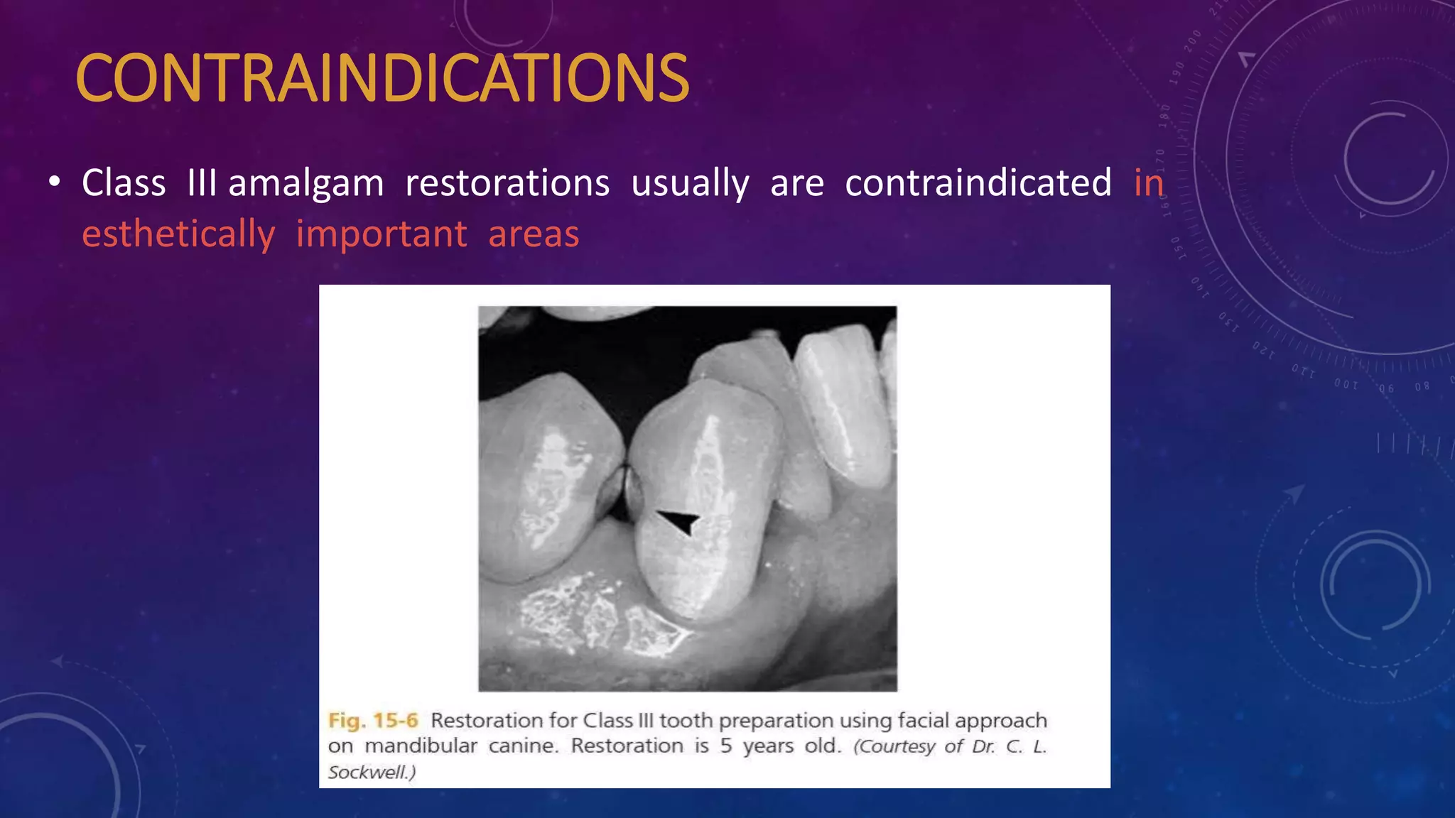 Class 3 tooth preparation | PPTX