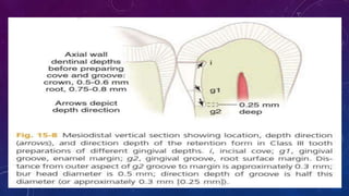 Class 3 tooth preparation | PPTX