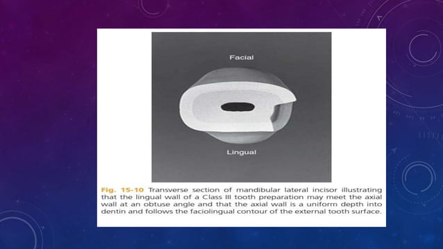 Class 3 tooth preparation | PPTX