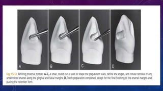 Class 3 tooth preparation | PPTX