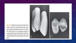 Class 3 tooth preparation | PPTX