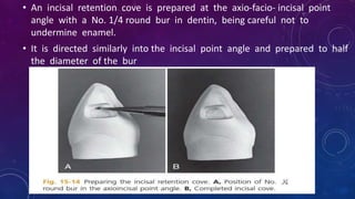 Class 3 tooth preparation | PPTX