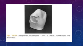 Class 3 tooth preparation | PPTX