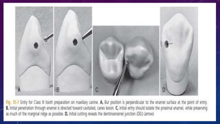 Class 3 tooth preparation | PPTX