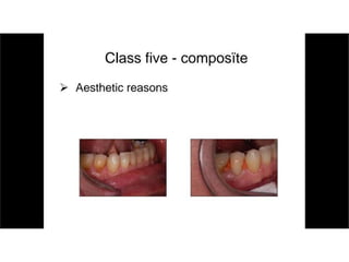 Class 5 cavity | PPTX