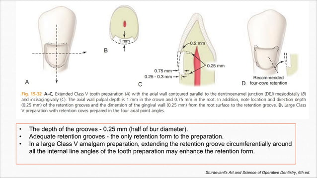 Class 5 cavity designs | PDF | Dental Health | Diseases and Conditions