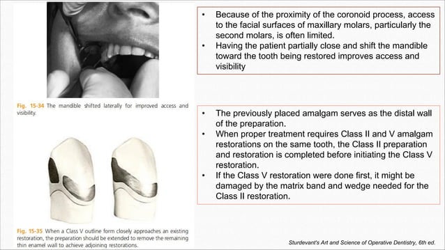 Class 5 cavity designs | PDF | Dental Health | Diseases and Conditions