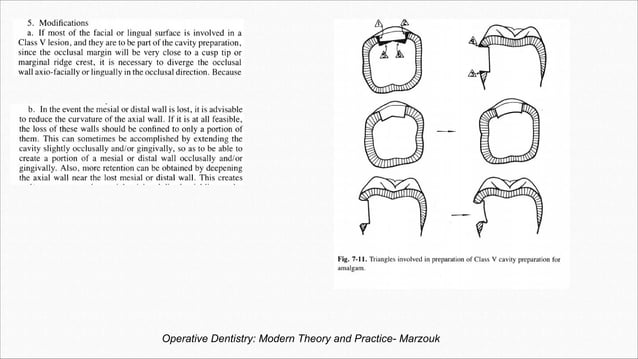 Class 5 cavity designs | PDF | Dental Health | Diseases and Conditions