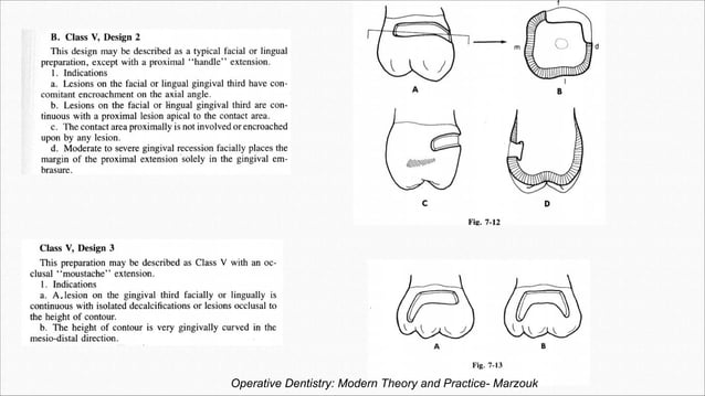 Class 5 cavity designs | PDF | Dental Health | Diseases and Conditions