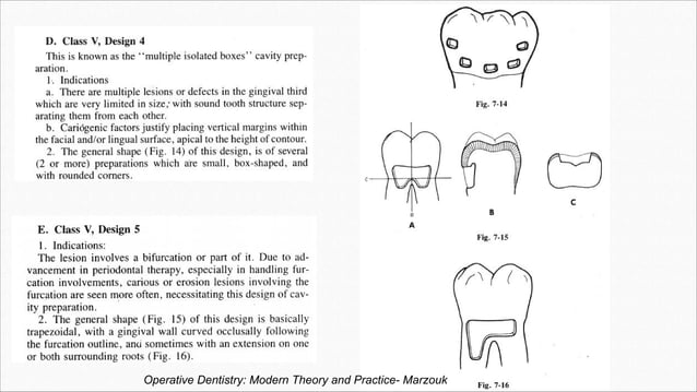 Class 5 cavity designs | PDF | Dental Health | Diseases and Conditions