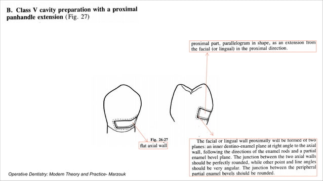 Class 5 cavity designs | PDF | Dental Health | Diseases and Conditions