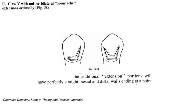 Class 5 cavity designs | PDF | Dental Health | Diseases and Conditions