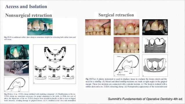 Class 5 cavity designs | PDF | Dental Health | Diseases and Conditions