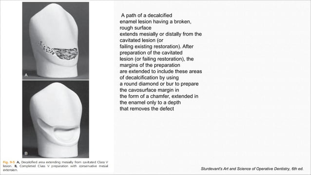 Class 5 cavity designs | PDF | Dental Health | Diseases and Conditions