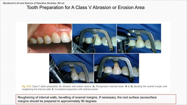 Class 5 cavity designs | PDF | Dental Health | Diseases and Conditions