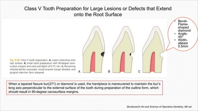 Class 5 cavity designs | PDF | Dental Health | Diseases and Conditions