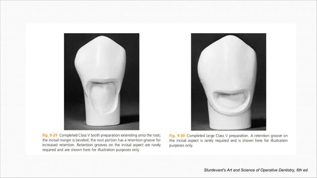 Class 5 cavity designs | PDF | Dental Health | Diseases and Conditions