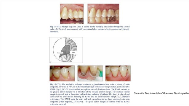 Class 5 cavity designs | PDF | Dental Health | Diseases and Conditions