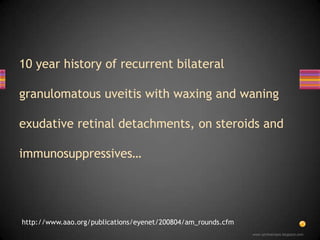 Panuveitis | PPTX