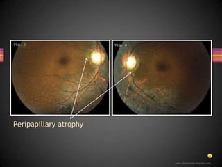 Panuveitis