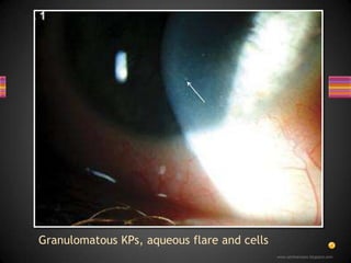 Panuveitis | PPT