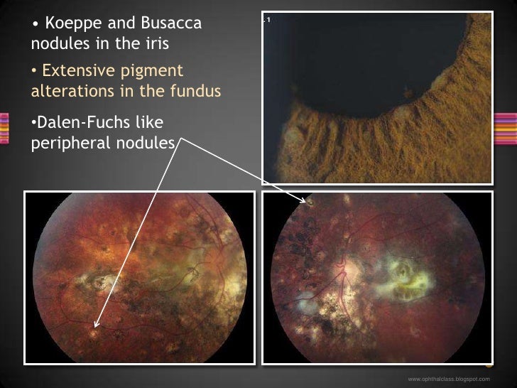 Panuveitis