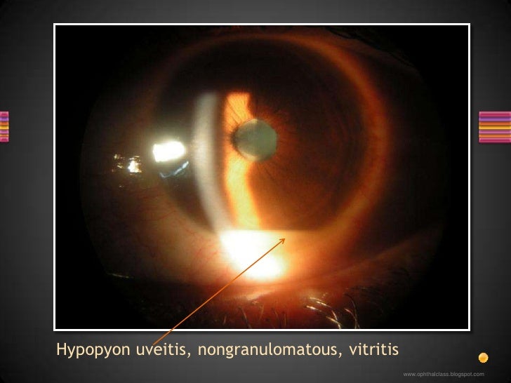 Vitritis