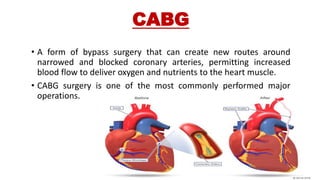 CLASS 7 - CABG.pptx